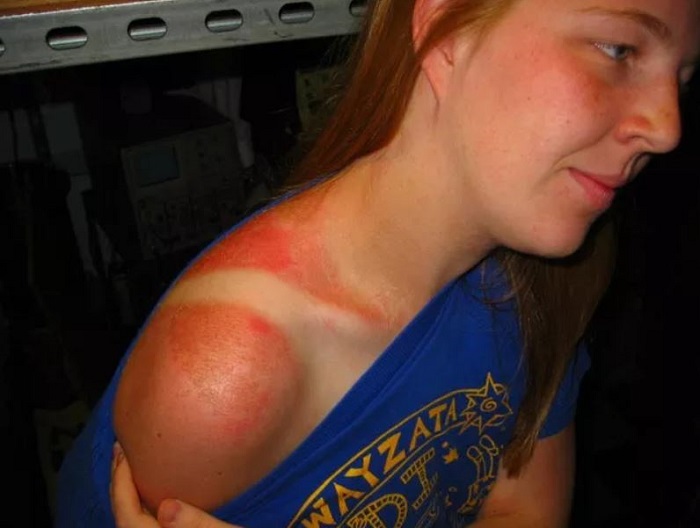 50 dreadfully bad sunburns