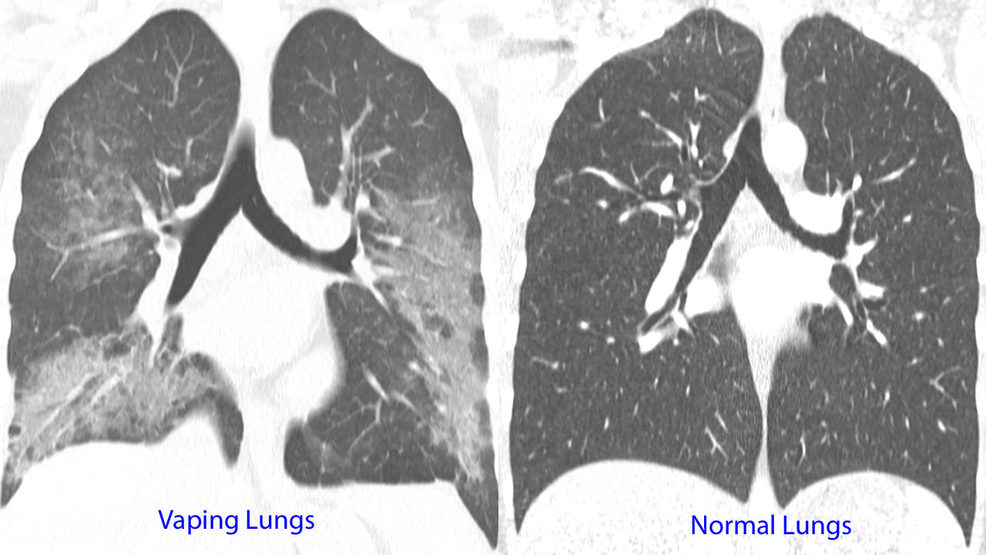 Teen warns peers against dangers of vaping after suffering permanent ...