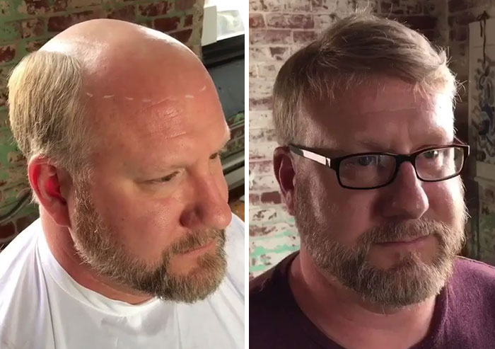 40 balding guys get a hair replacement and upgrade their looks