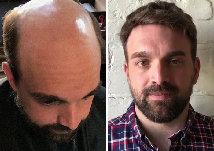 40 balding guys get a hair replacement and upgrade their looks