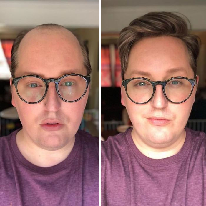 40 balding guys get a hair replacement and upgrade their looks