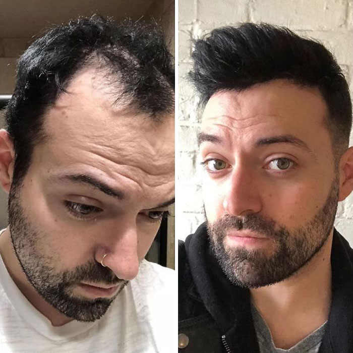 40 balding guys get a hair replacement and upgrade their looks