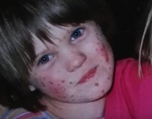 Girl born with spots all over was bullied for her appearance – then she ...