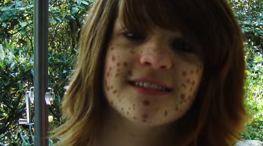 Girl born with spots all over was bullied for her appearance – then she ...