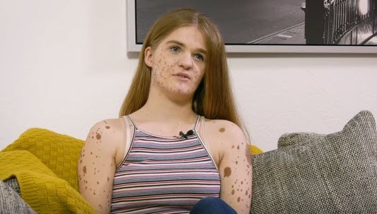 Girl born with spots all over was bullied for her appearance – then she ...