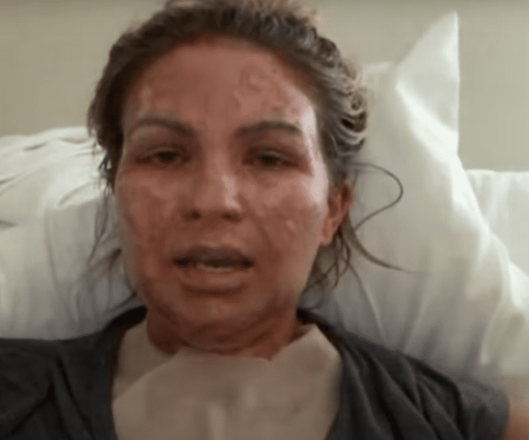 Mom Badly Burned When Hand Sanitizer Catches Fire