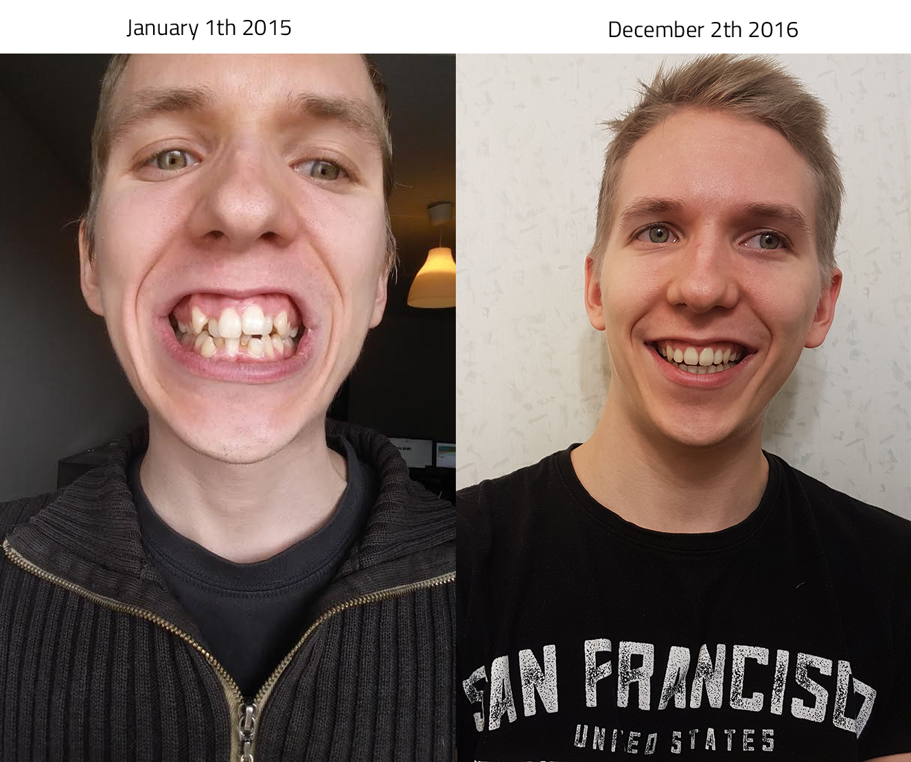 75 drastic transformations of people before and after braces