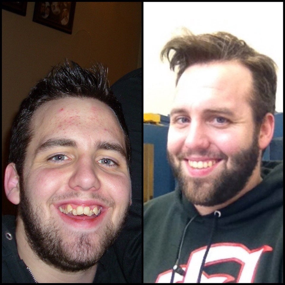 75 drastic transformations of people before and after braces