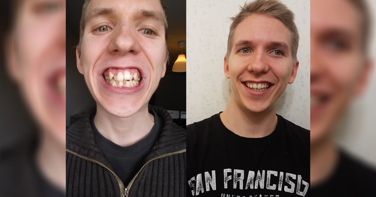 75 drastic transformations of people before and after braces